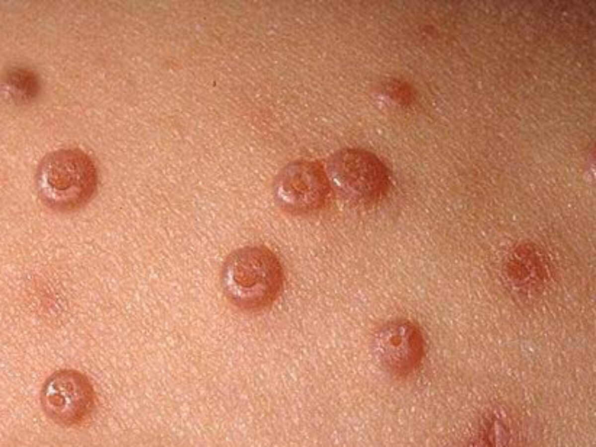 Tratamiento De Cicatrices Molusco Contagioso